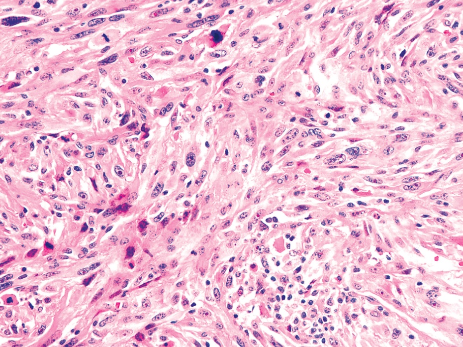 Pathology Outlines Undifferentiated Pleomorphic Sarcoma